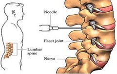 Facet Joint Injections, Cervical and Lumbar - Best Pain Doctor NYC
