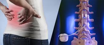 What Are Spinal Pumps for Chronic Pain? - Best Pain Doctor NYC