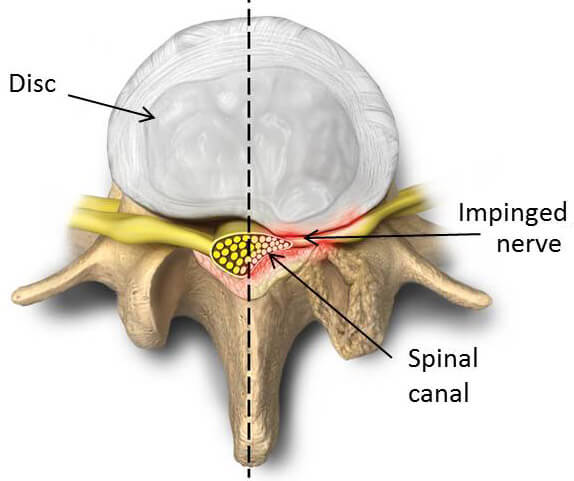 Cervical Epidural Steroid Injections Doctor NYC - Best Pain Doctor NYC